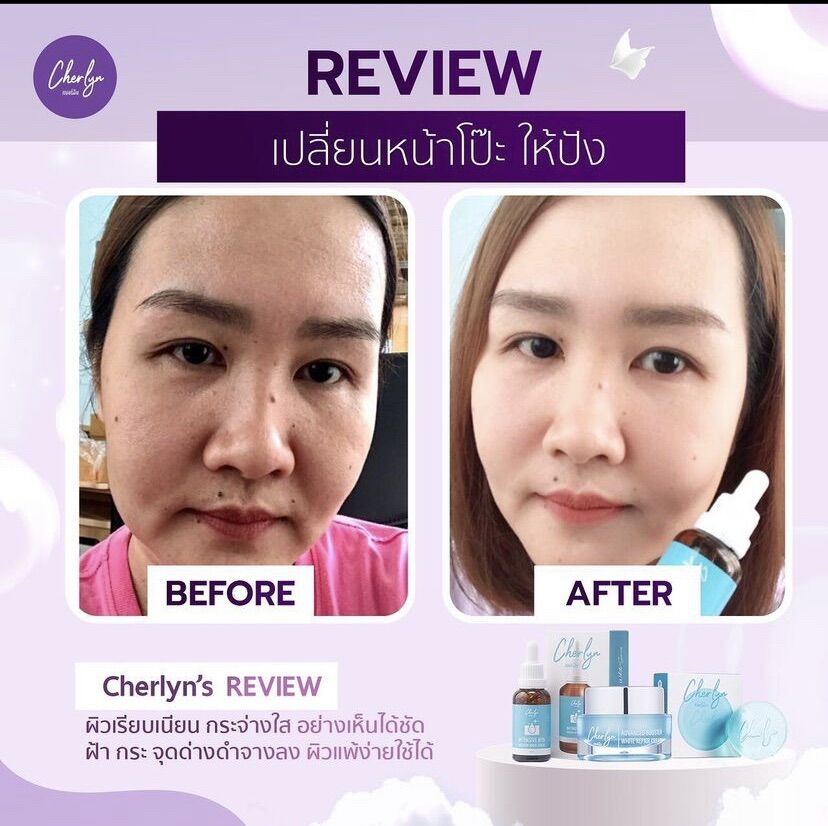 ถูกสุด‼️ของแท้????Cherlyn ครีม สำหรับ ฝ้า กระ จุดด่างดำ สิว สิวอักเสบ ...