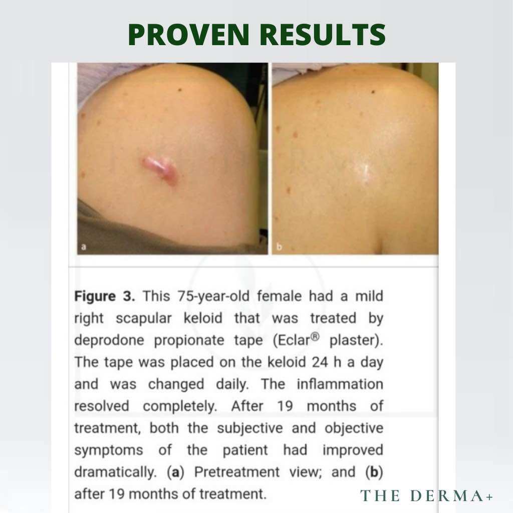 Japan Scar Removal Keloid Treatment - Hisamitsu Eclar Plaster ...