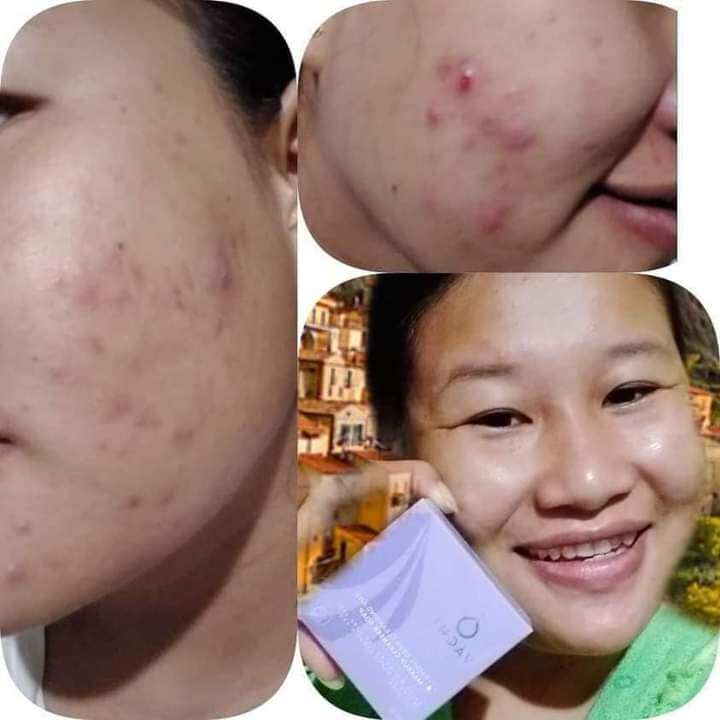 ဝက္ၿခံေတြ ထြက္😔😔😔 အဆီျပန္.🤔🤔🤔 အသားရည္ ေျခာက္ေသြ႕ေနတုန္းလား.. ဒါဆို... 💜 ...