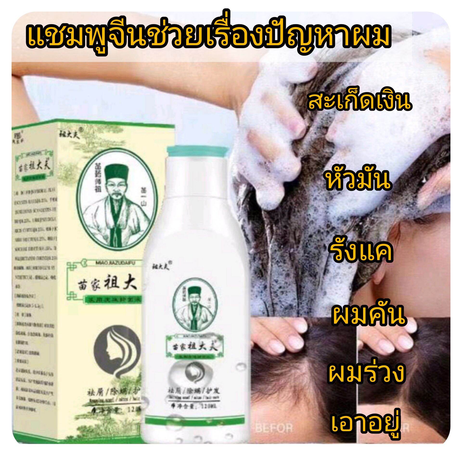 ☘แชมพูZudaifuของแท้ ใช้แล้วเห็นผล แชมพูสำหรับสะเก็ดเงิน มีรังแค คัน ...