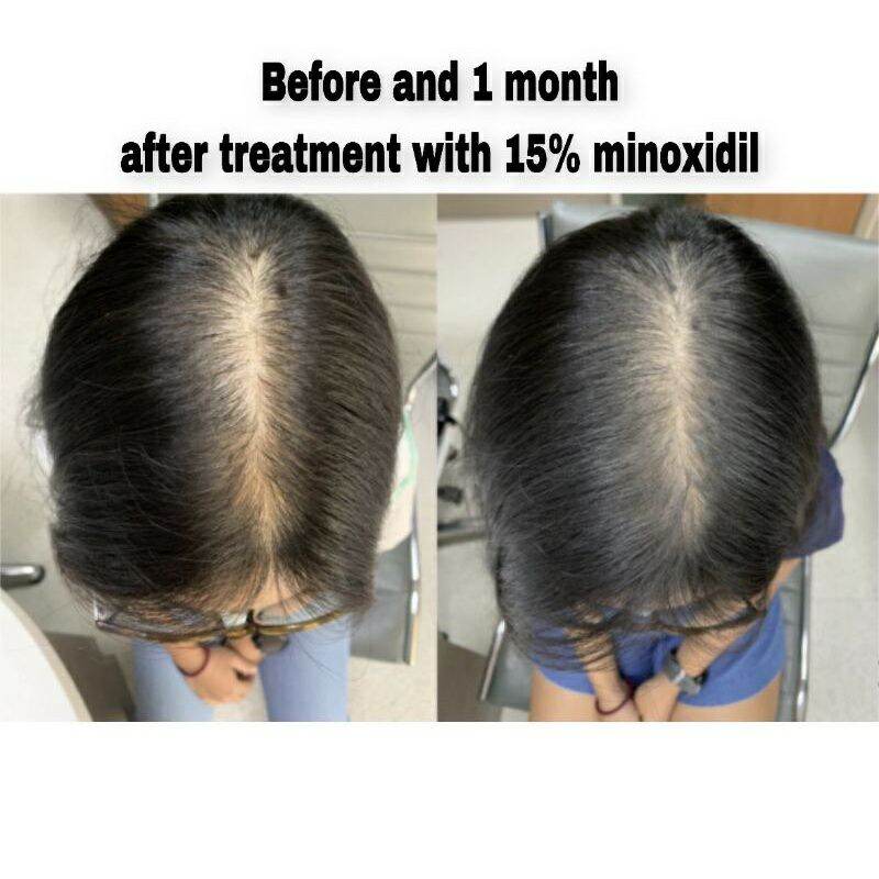 Hair loss solution 15 Minoxi - Good Hair 888 - ThaiPick