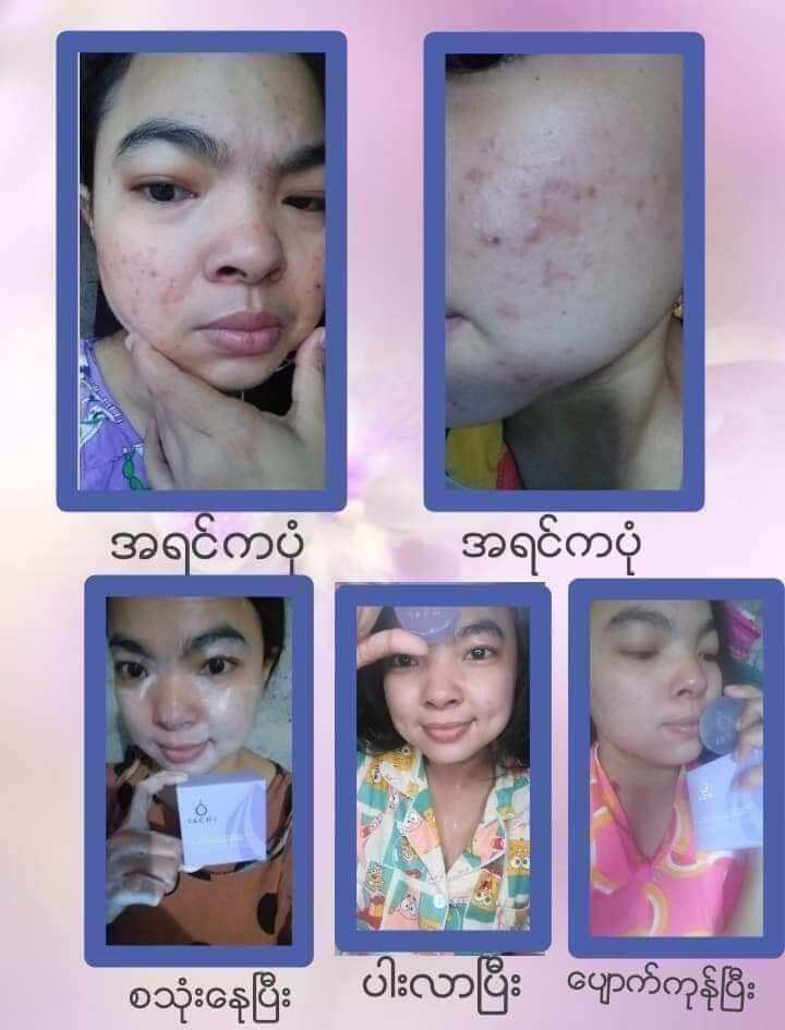 VaChi မ်က္ႏွာသစ္ေလးက. ေရးဓာတ္ျဖည့္ေပးတယ္ မ်က္ႏွာအသားျဖဴျမန္တယ္ တင္းတိပ္ ...