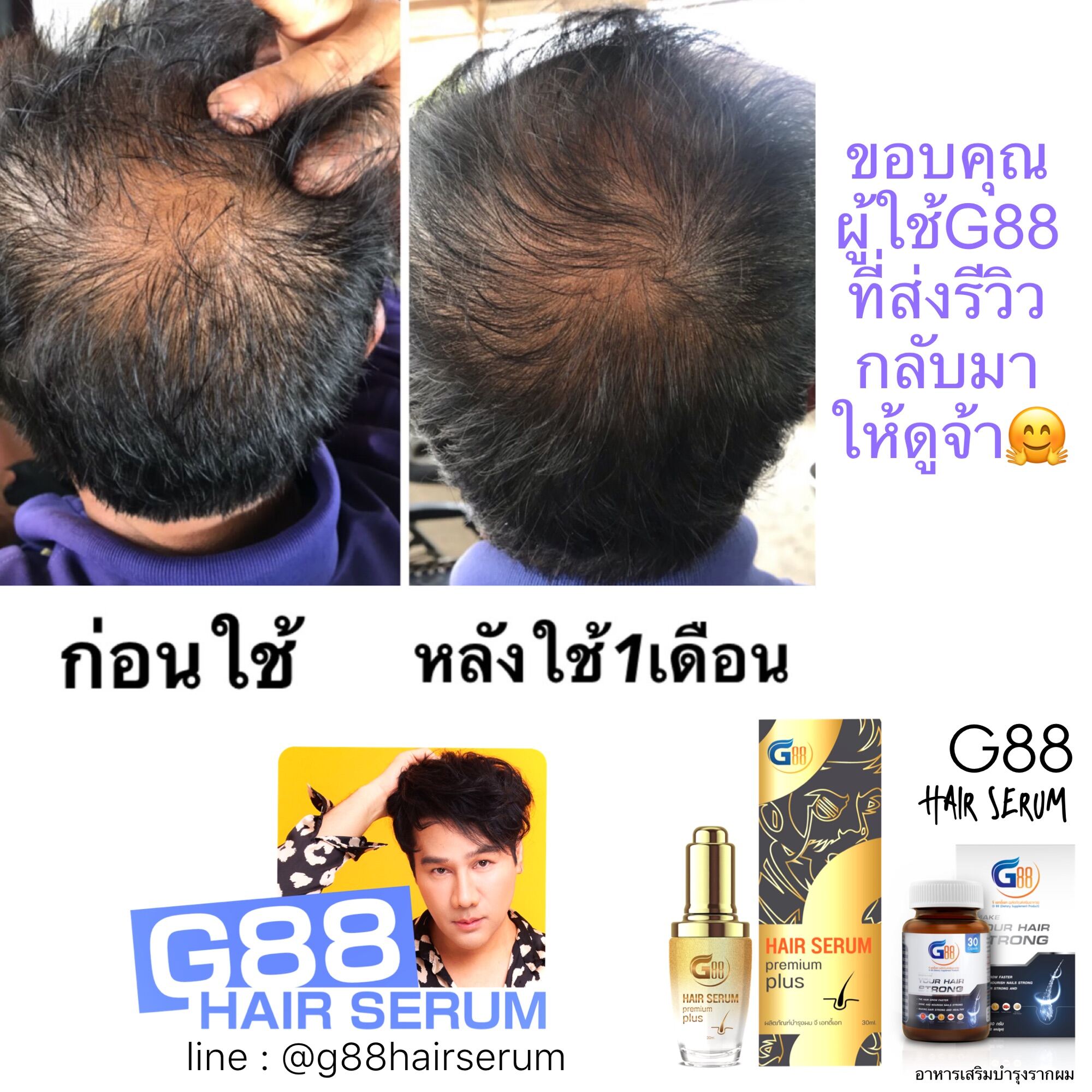Best Set G88 hair serum plus G88 shampoo (ของแท้) ลดผมร่วง ปลูกผม - G88 HAIR SERUM - ThaiPick